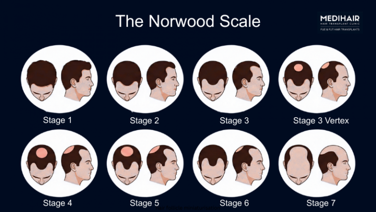 Male Pattern Baldness - Medihair | Medihair